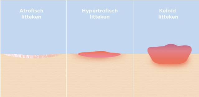 Littekens - Laat uw littekens verdwijnen bij Cosmedic Team op Urk!